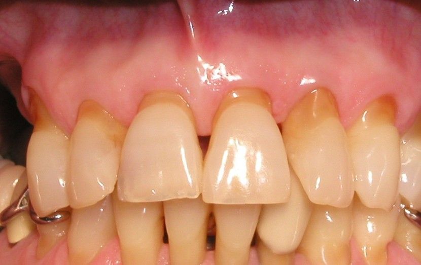 Parodontopatija - Dental Atelier